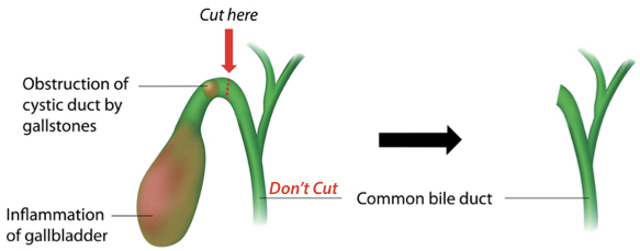 Gallbladder Duct Surgery Complications; Common Hepatic Duct | Clore Law ...
